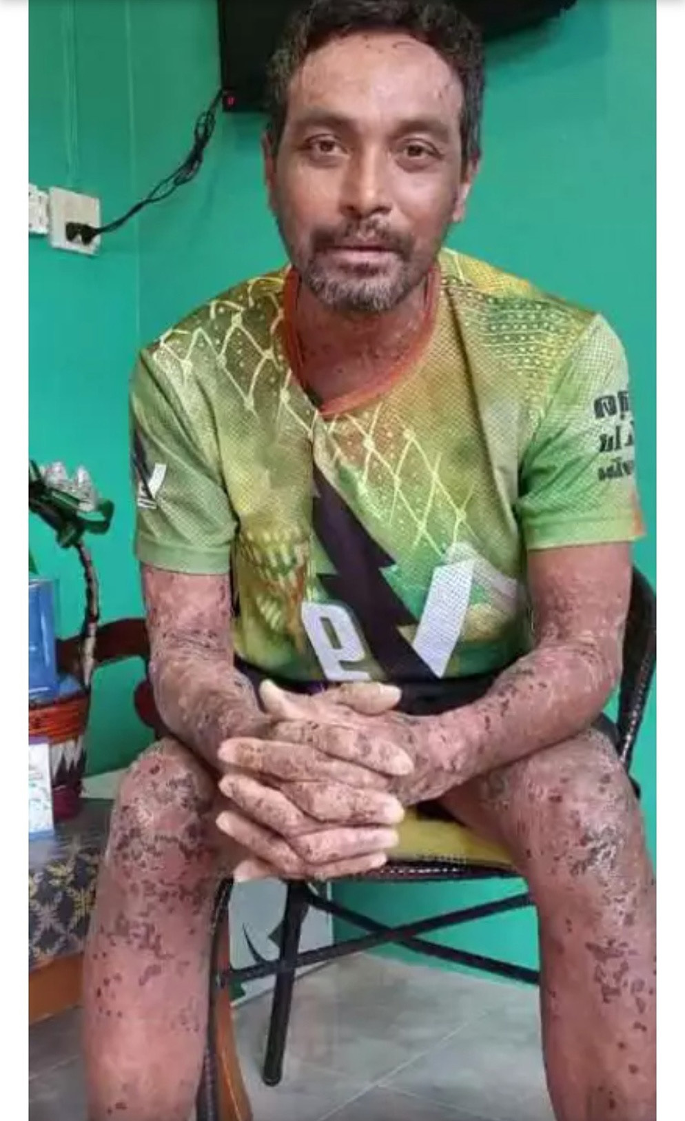 Hero Filem Nang Nak Meninggal Dunia Selepas Lima Tahun Hidap Penyakit Kulit